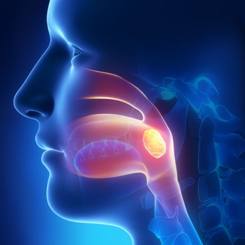 Mikor segít a savós középfülgyulladáson az orrmandula műtét?